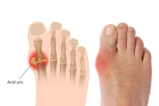 Nhận biết các dấu hiệu bệnh gút cần điều trị ngay lập tức